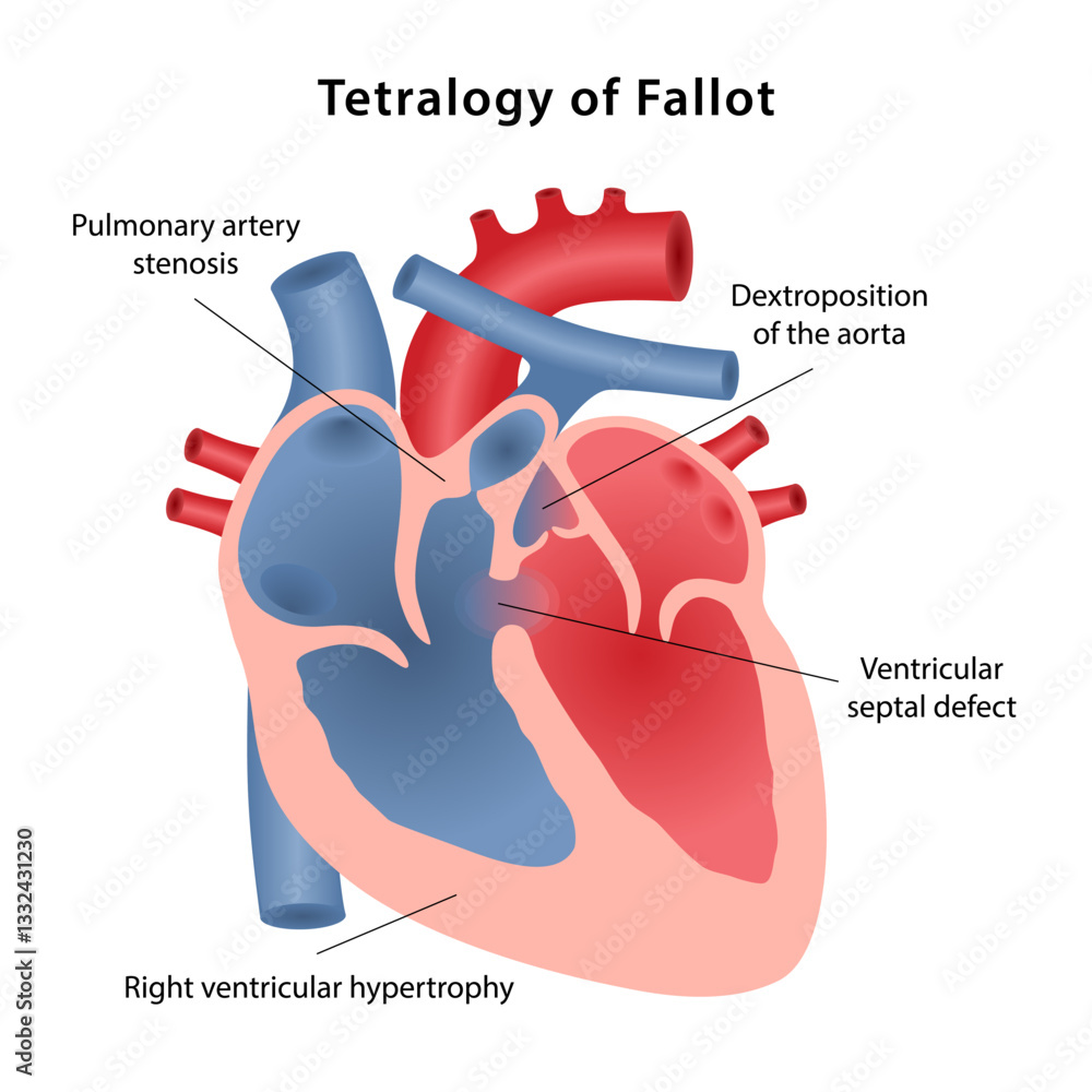 Tetralogy of Fallot, cardiac anomalies: pulmonary artery stenosis; ventricular septal defect ...