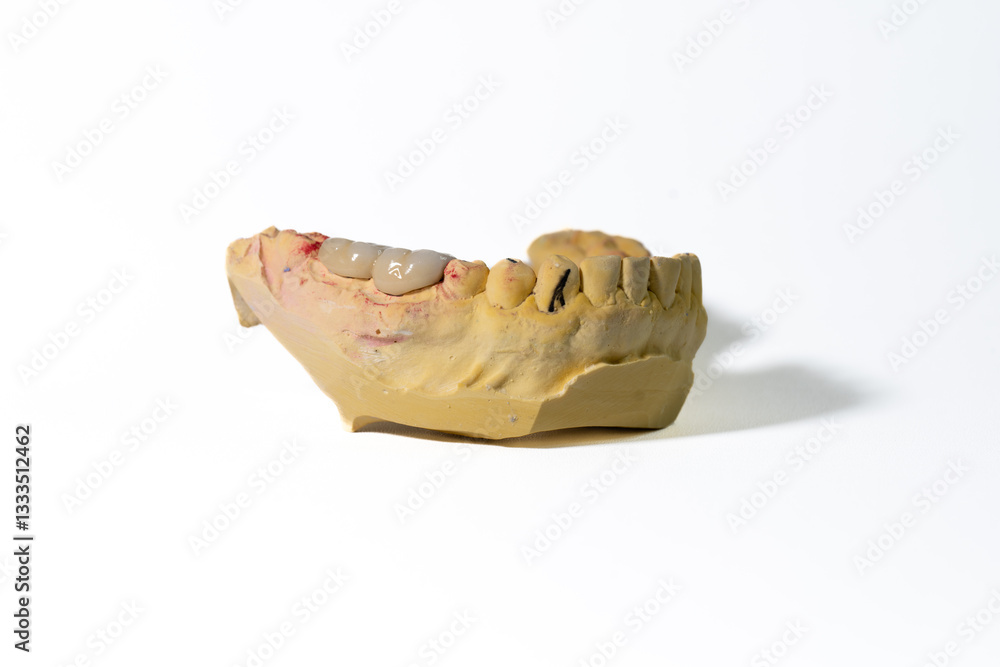 Dental stone model showing the lower jaw with a porcelain metal denture ...