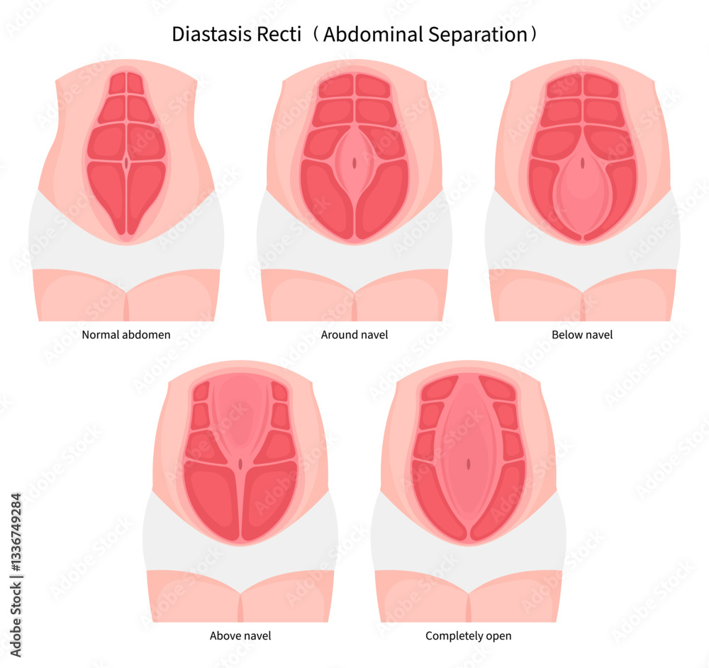 Type of abdominal muscle separation after surgical which in medical called Diastasis Recti belly ...