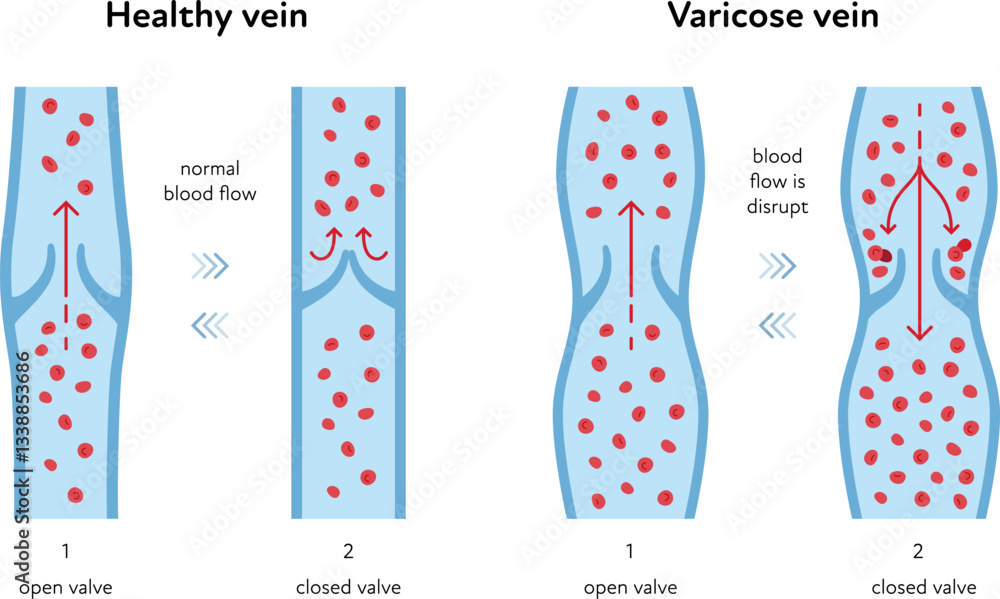 Varicose disease for healthcare infographic. Vector flat chart ...