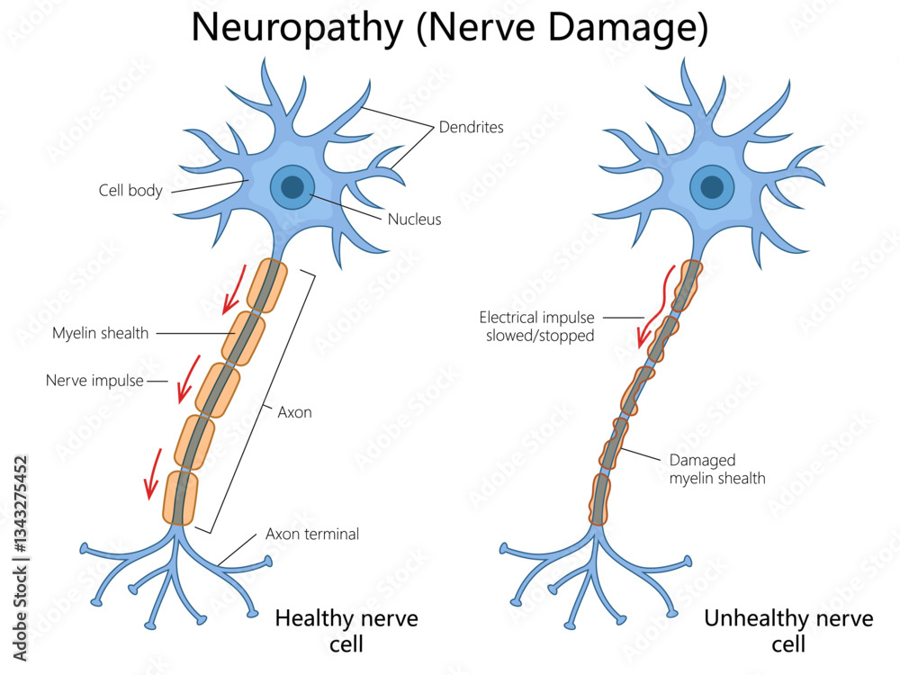 healthy and damaged nerve cells, showing myelin sheath deterioration ...
