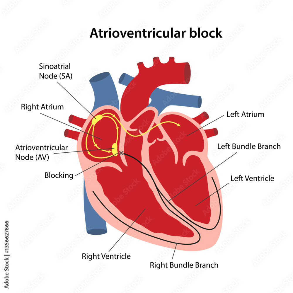 Atrioventricular block. Image of human heart with cardiac conduction ...
