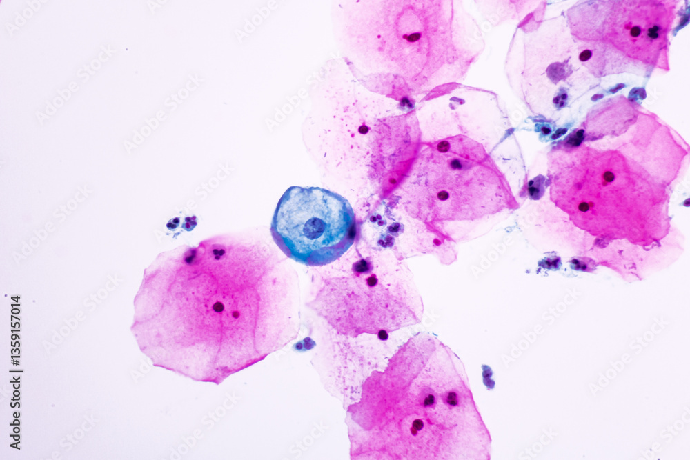 View in microscopic of koilocyte cell criteria of HPV (Human Papilloma ...