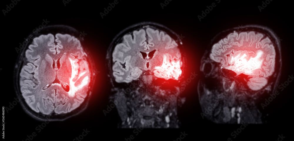 MRI scan reveals a lesion in the left hemisphere of the brain ...