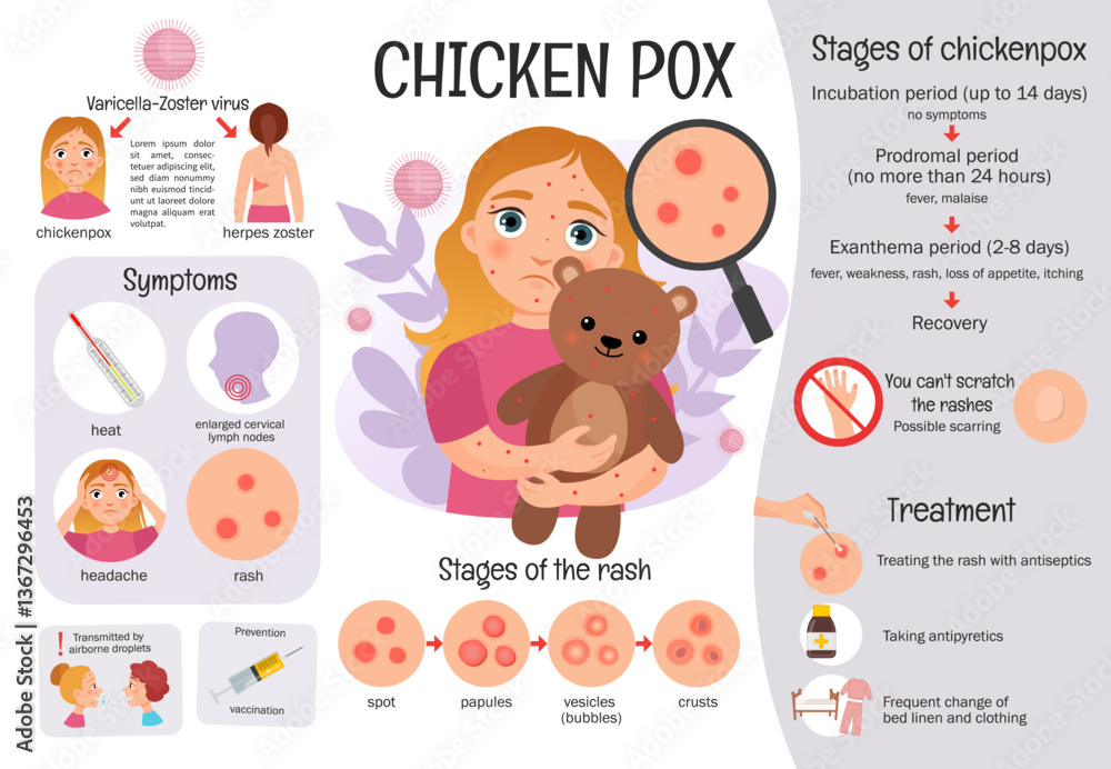 Stock-Vektorgrafik „Vector infographic chickenpox. Illustration of cute ...