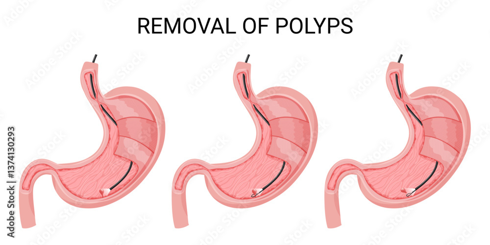 Step by step process of removing a polyp from the stomach using an ...