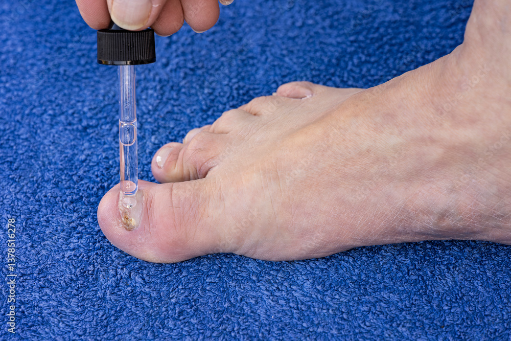 Treating Fungal Nail Infection - Applying Antifungal Ointment to ...