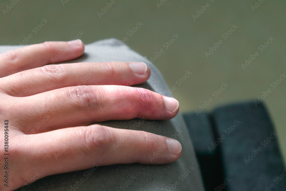 Mallet finger healing after splint removal from middle finger following ...