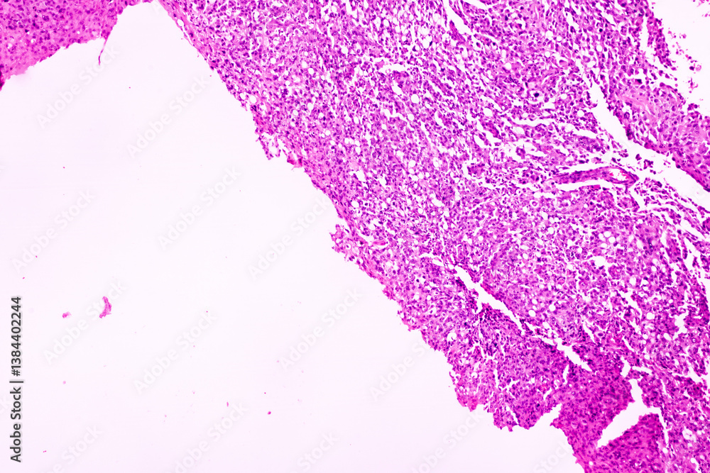 Backgrounds of human cells tissue of lung human under the microscope in ...