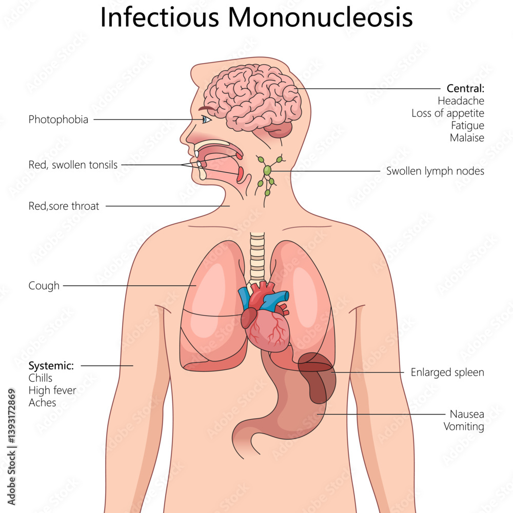 how infectious mononucleosis affects the body, including systemic, respiratory, digestive, and ...
