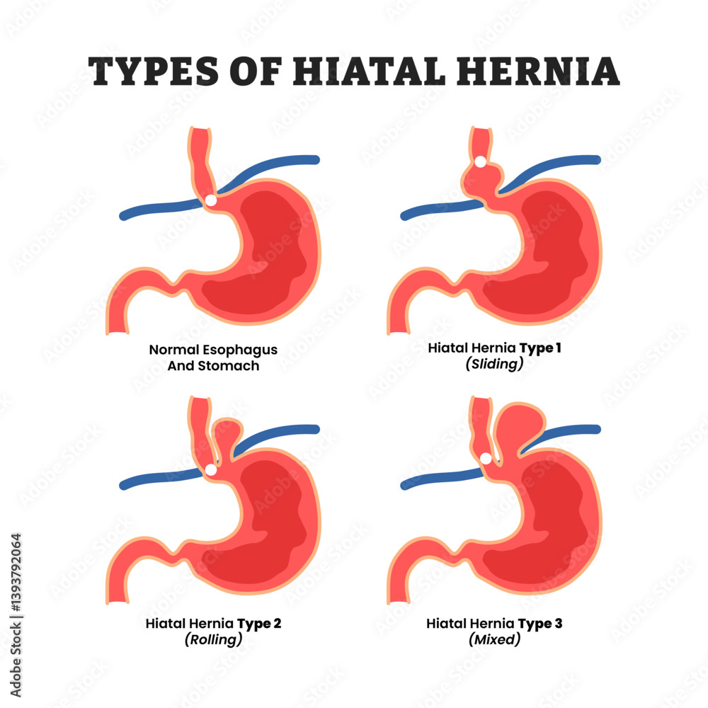Different types of hiatal hernia types, educational medical poster ...