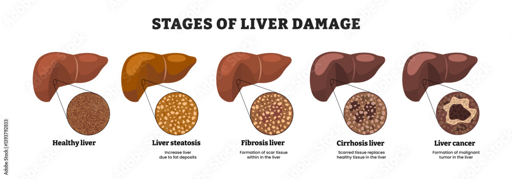 Stages of liver damage stages progress, educational medical poster ...