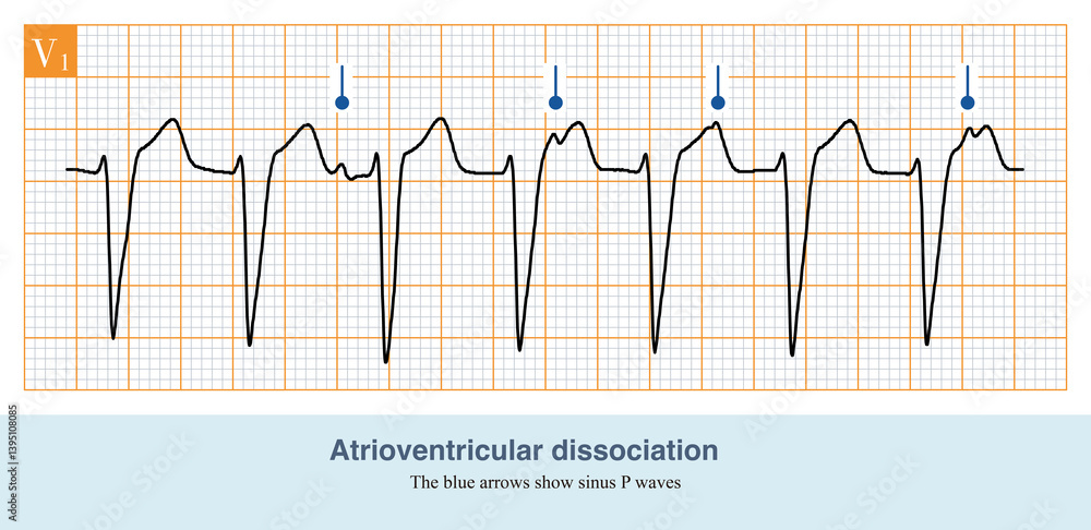 Ilustración de Stock If atrioventricular dissociation can be observed ...