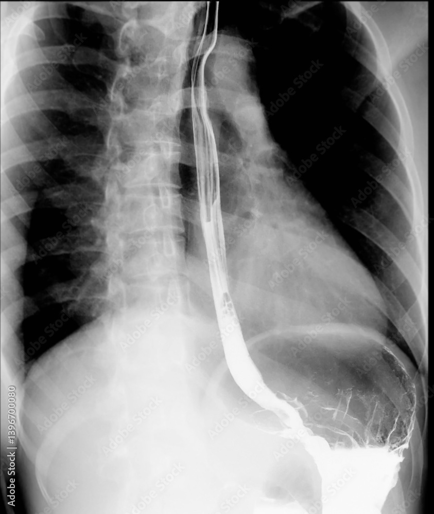 Barium Swallow study test diagnose Barrett's GI tract exam GERD ulcers ...