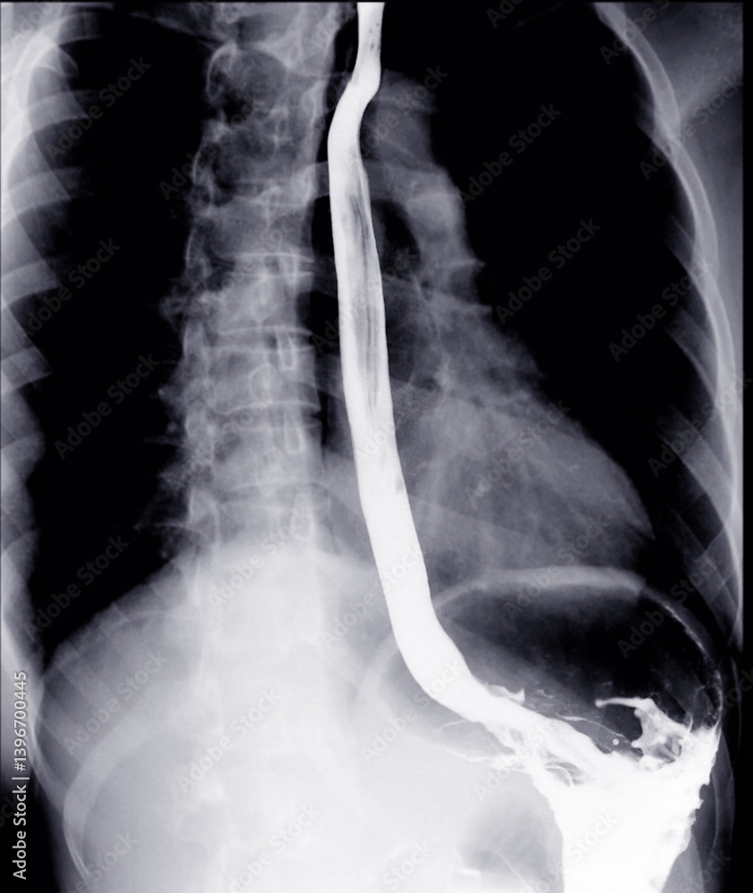 Barium Swallow study test diagnose Barrett's GI tract exam GERD ulcers ...