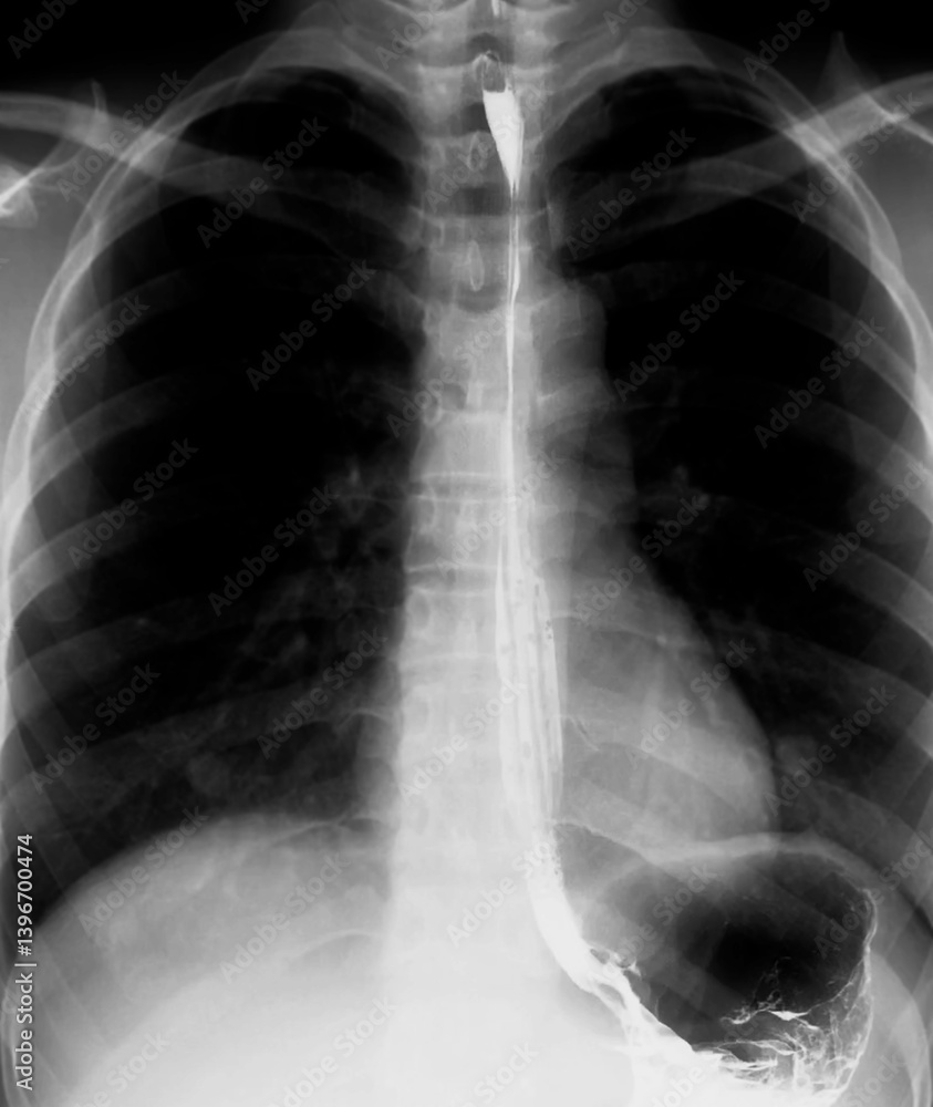 Barium Swallow study test diagnose Barrett's GI tract exam GERD ulcers ...