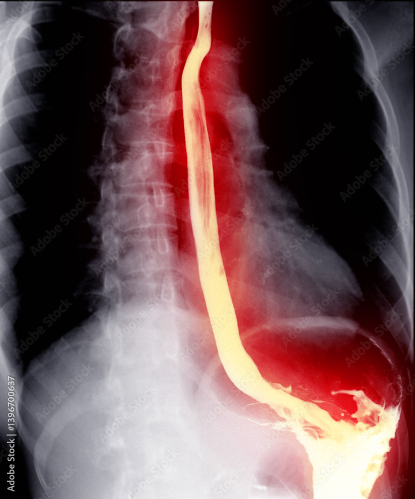 Barium Swallow study test diagnose Barrett's GI tract exam GERD ulcers ...
