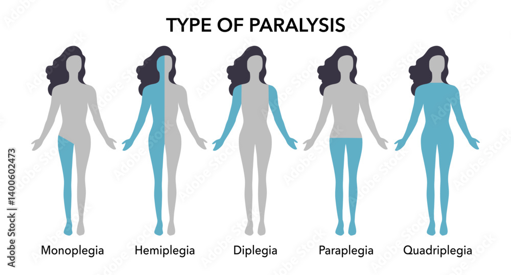 Types of paralysis and limb body parts as medical condition outline ...