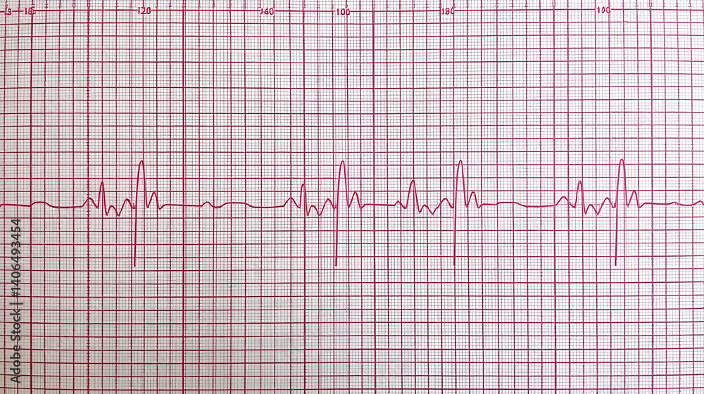 ECG Premature Ventricular Contraction Multiform / Multifocal - 8 Second ECG Paper - Ventricular ...