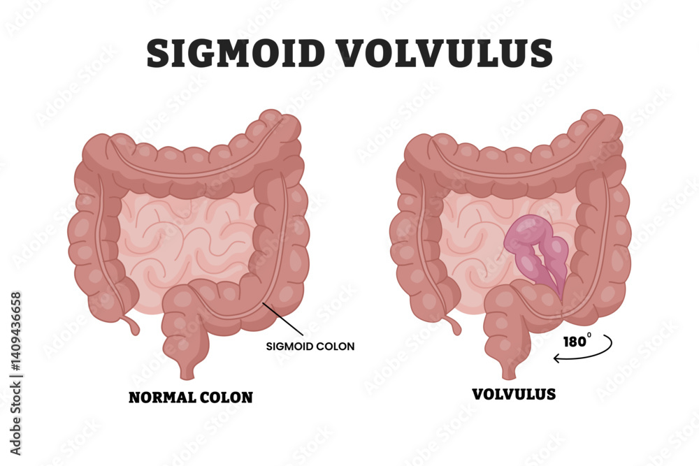 Sigmoid Volvulus vs Normal Colon Medical Diagram, educational medical poster design healthcare ...