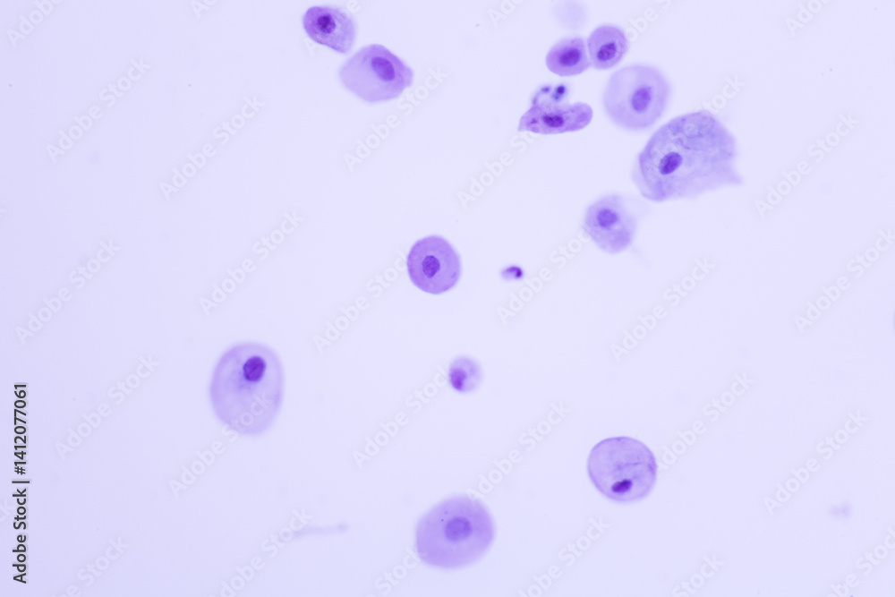 Human normal squamous epithelial cells view in microscopy.Atrophic ...