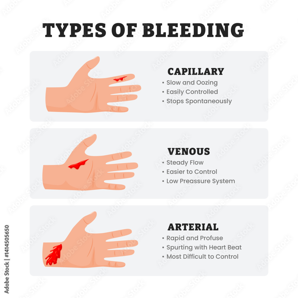 Different Types Of Various Bleeding Types In Hand Gesture Educational Different Types Of Various Bleeding Types In Hand Gesture Educational