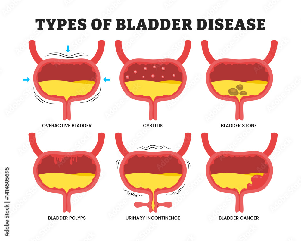 Vector de Stock Different types of various bladder disease types ...