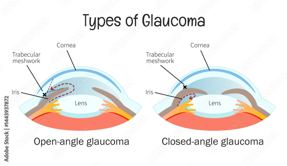Vector medical poster types of glaucoma. Open-angle and closed-angle glaucoma on eye anatomy ...