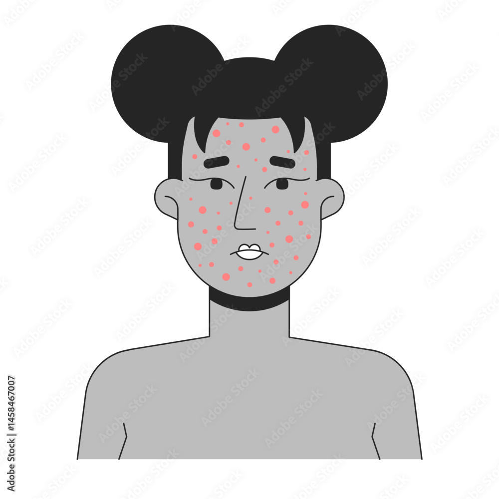 Black woman face with severe acne outline illustration. Pimples ...
