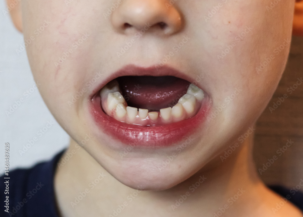 Smile of a child with milk teeth. The first baby tooth that fell out ...
