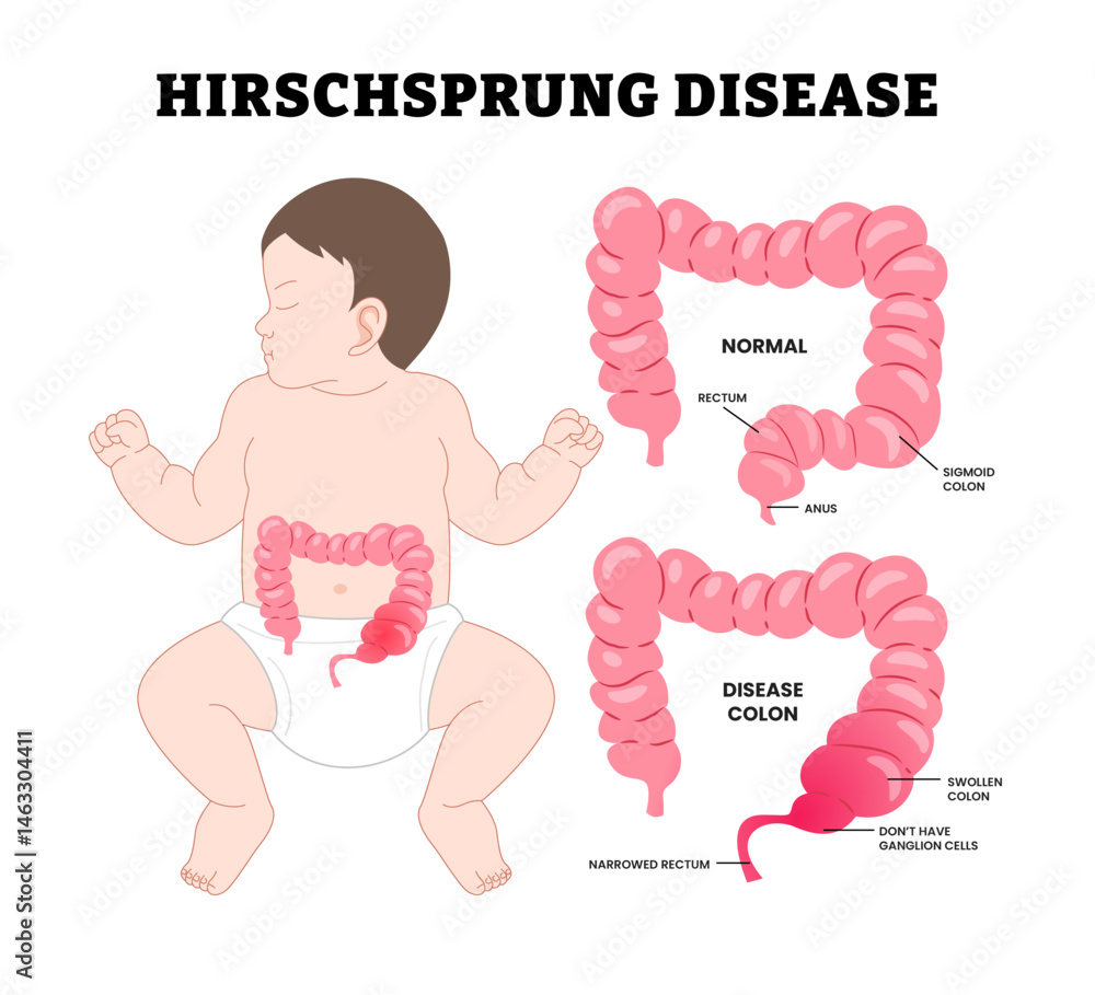 Baby hirschsprung disease, educational medical poster design healthcare ...