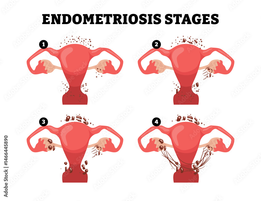 Stages of Endometriosis stages growth progress, female reproductive ...