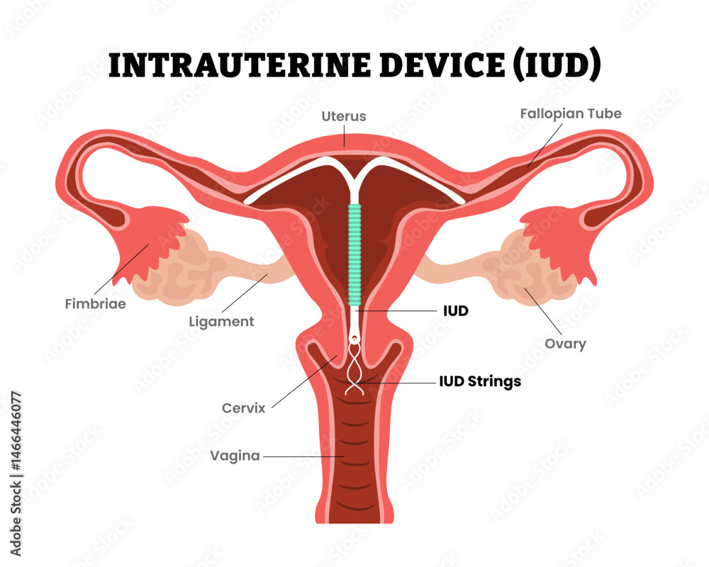 เวกเตอร์ Stock Intrauterine Device (IUD) or copper coil birth control ...