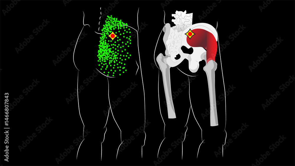 Trigger points and referred pain in the gluteus medius muscle Stock ...