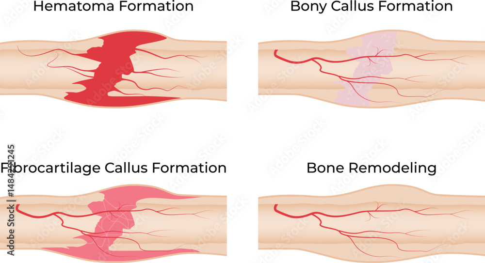Stages of Bone Fracture Healing Hematoma Callus Formation and ...