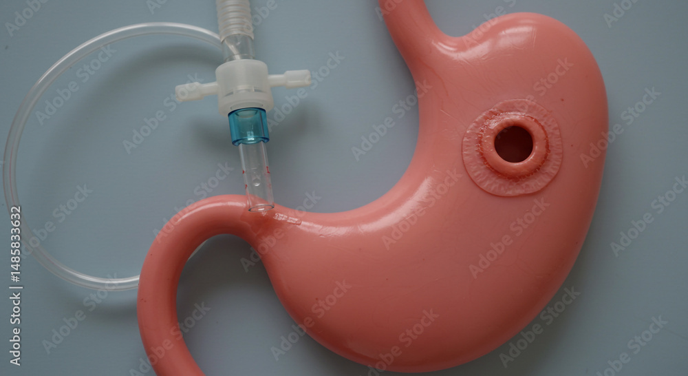 Exploring Gastric Feeding Tube Placement and Artificial Nutrition for ...