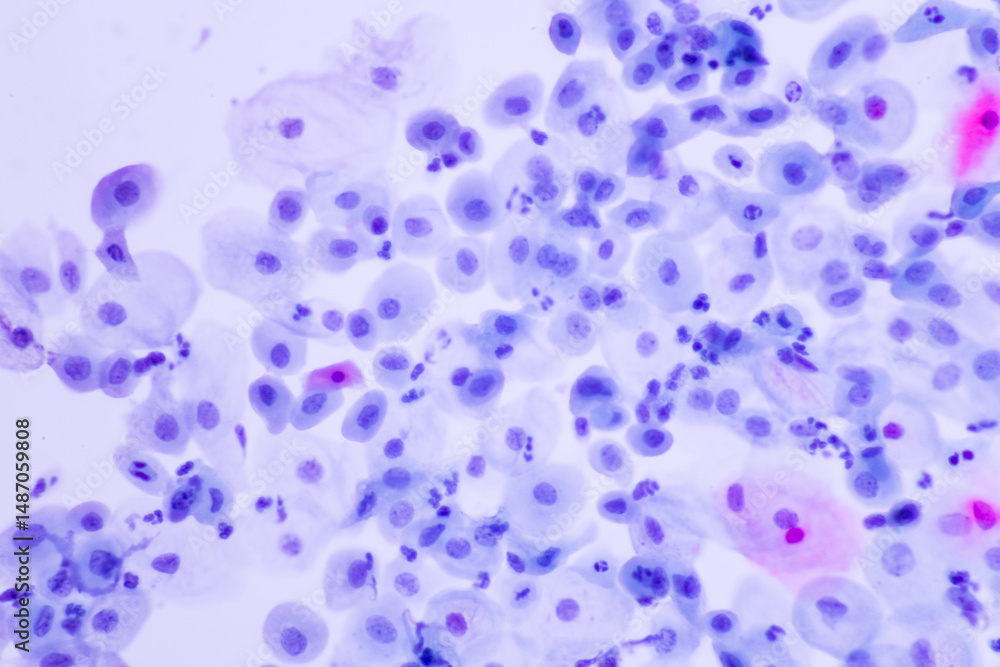 Human normal squamous epithelial cells view in microscopy.Atrophic ...