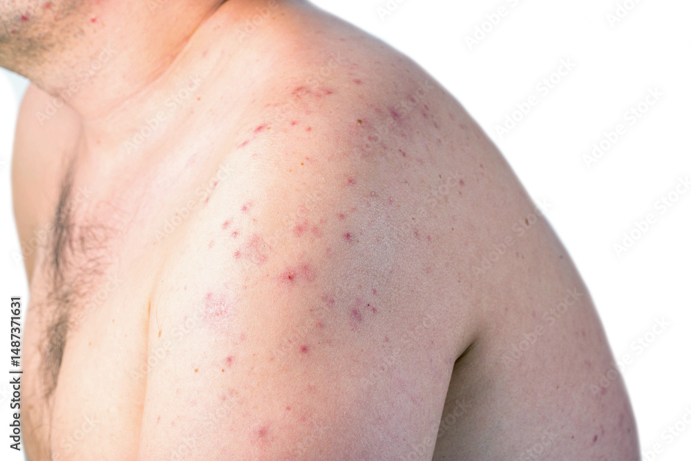 Red spots and rashes on the skin of a man s shoulders due to a reaction ...