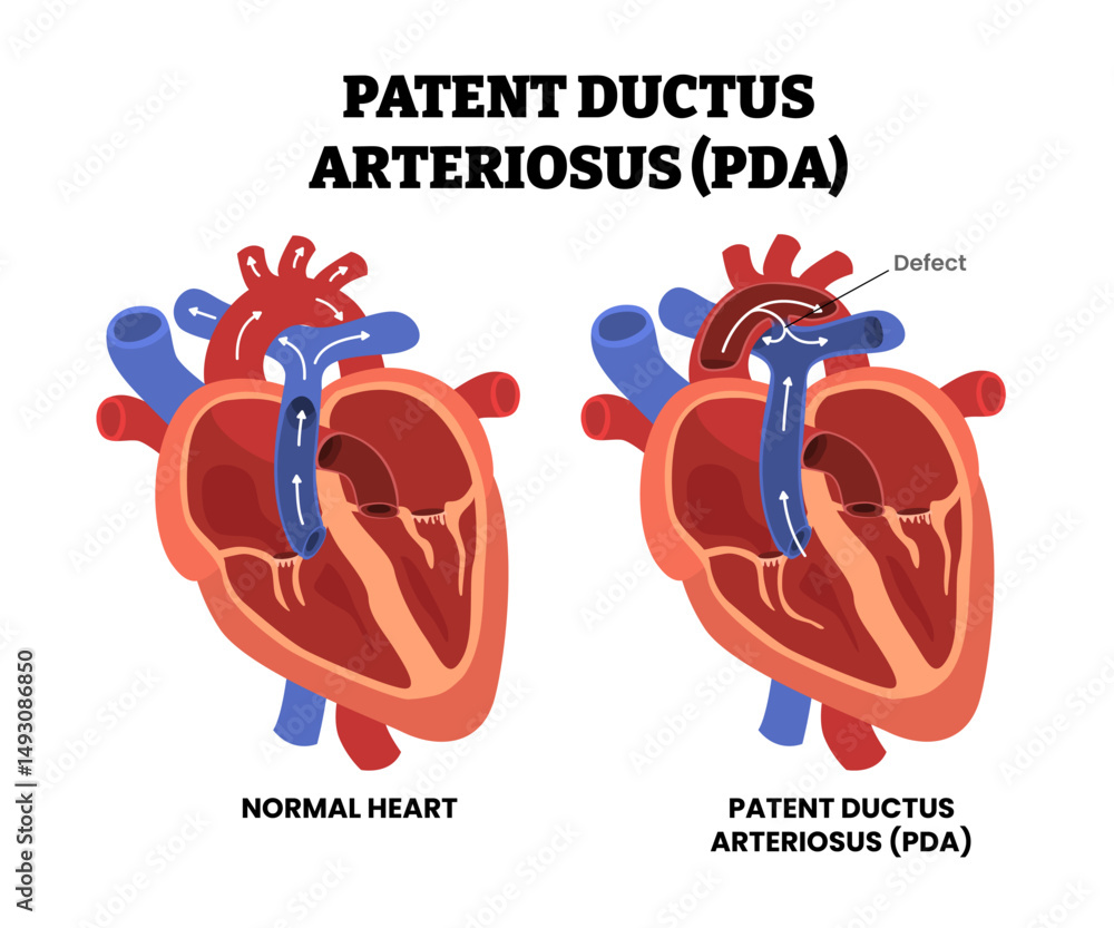 Heart Patent Ductus Arteriosus (PDA), educational medical poster design ...