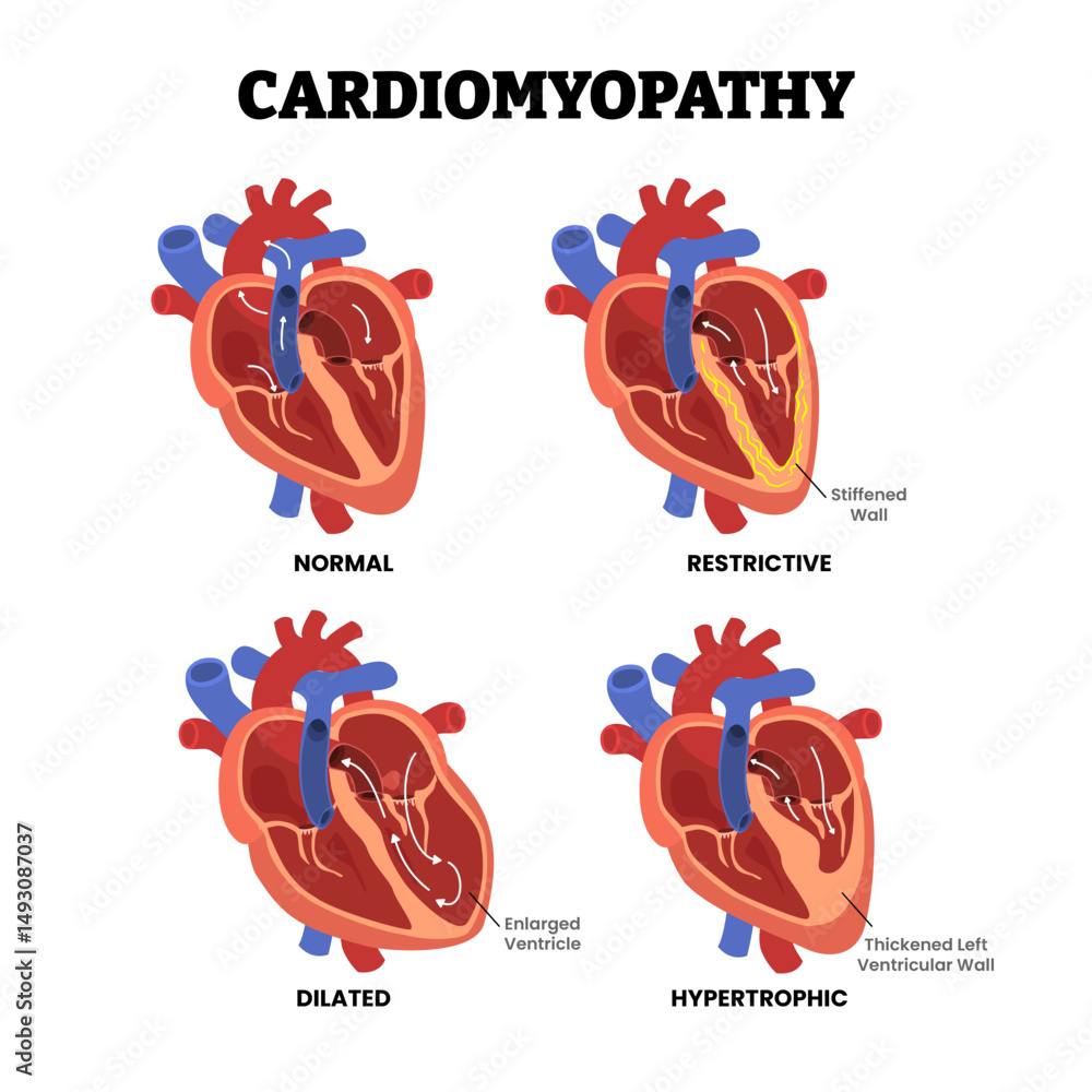 Cardiomyopathy types, heart muscle disease, educational medical poster ...