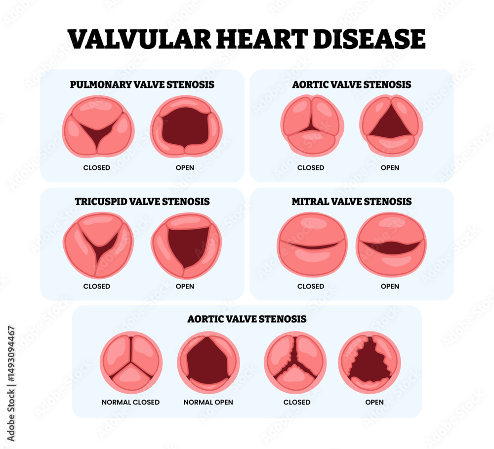Стоковое векторное изображение «Valvular heart disease, educational ...