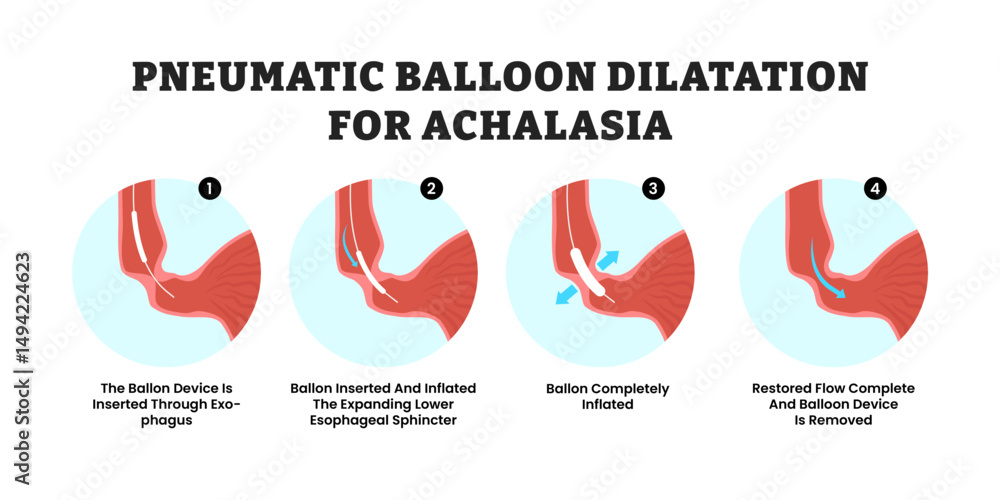 Pneumatic Balloon Dilatation for Achalasia Procedure Steps, Stomach ...