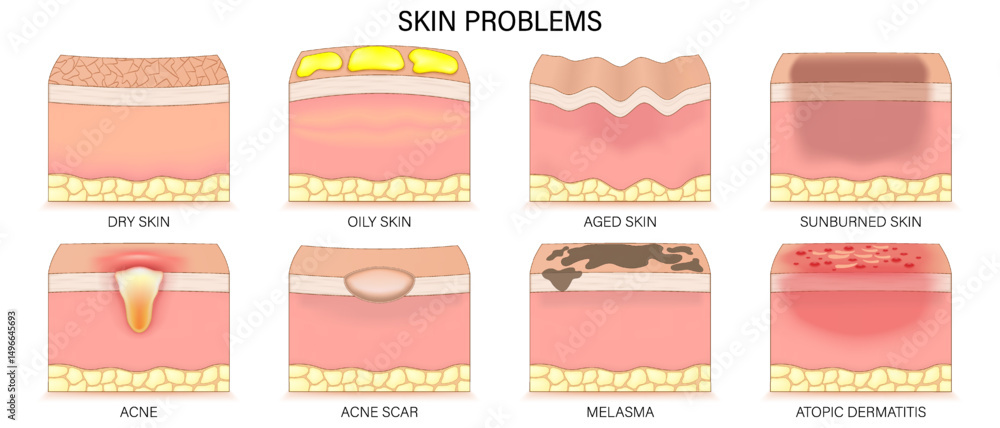 Structure of oily skin. Comparison of normal and oily skin. Facial skin ...