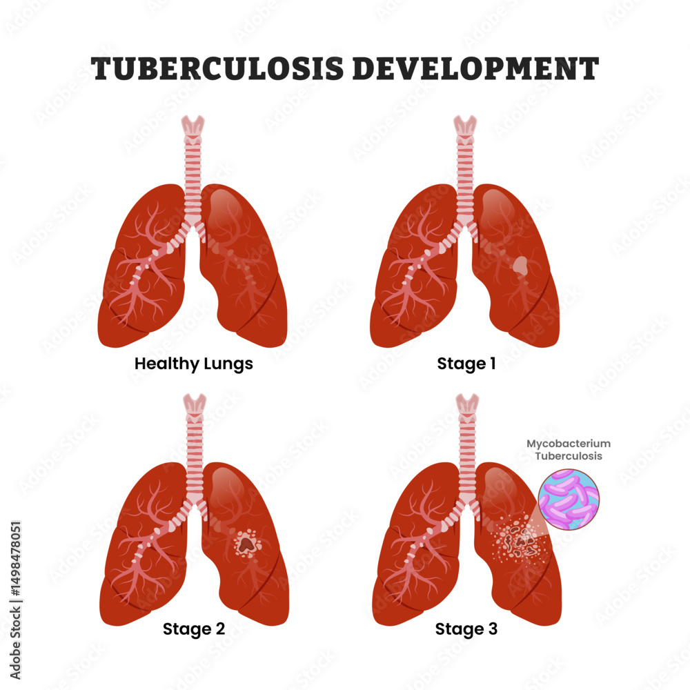 Stock-Vektorgrafik „TB Tuberculosis Development Stages Diagram Process ...