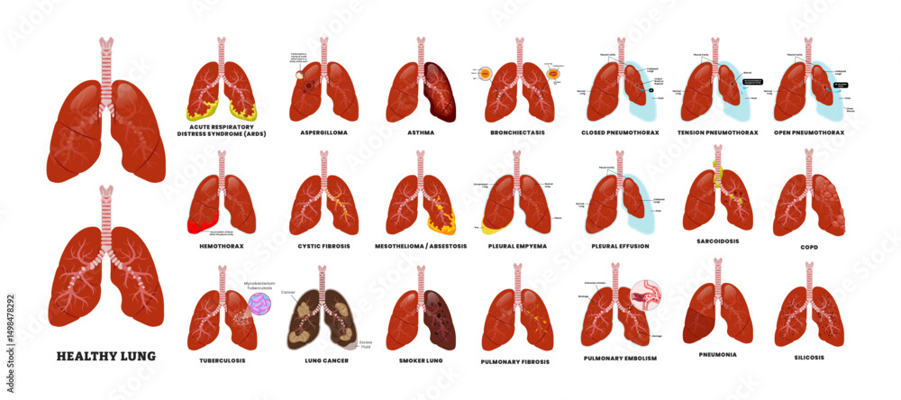Big Set of Lung Disease set collection, educational medical poster ...