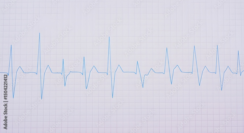 Normal ECG EKG Heart Rhythm Strip Medical Chart Cardiology ...