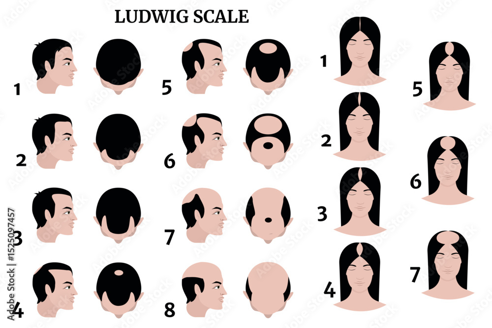 Ludwig scale illustration showing stages of hair loss in men and women ...