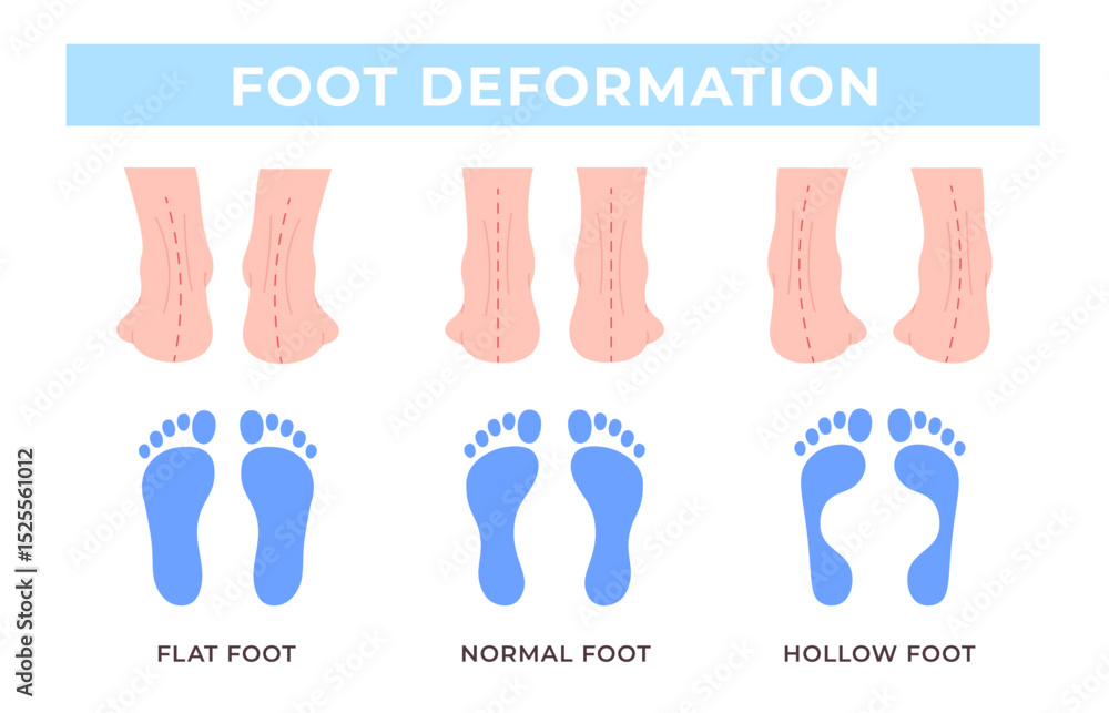 Praca wektorowa bez tantiem: Foot deformation medical poster. Feet ...