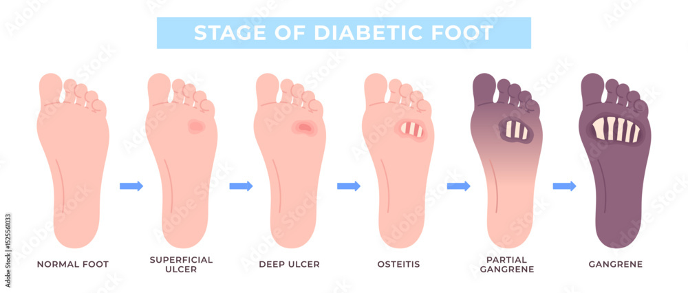 Stock-Vektorgrafik „Diabetic foot. Various stages of diabetes feet ...