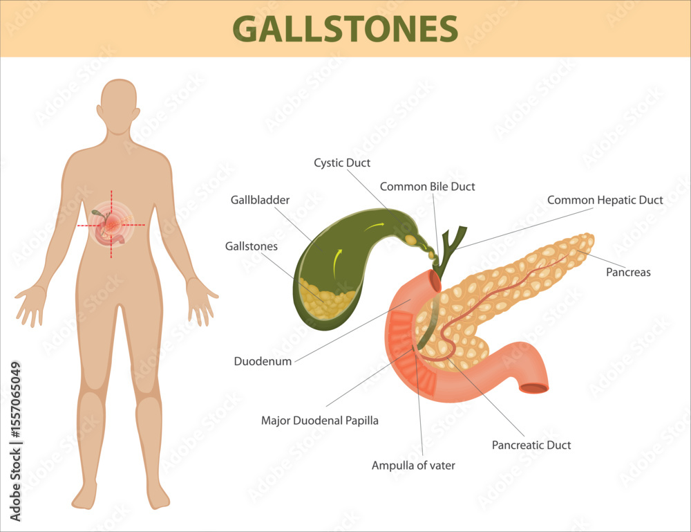 Стоковое векторное изображение «Anatomical diagram showing gallstones ...